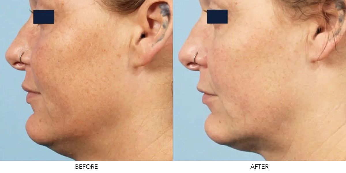 Matrix™ RF Microneedling - Chic Med Laser & Esthetic Center