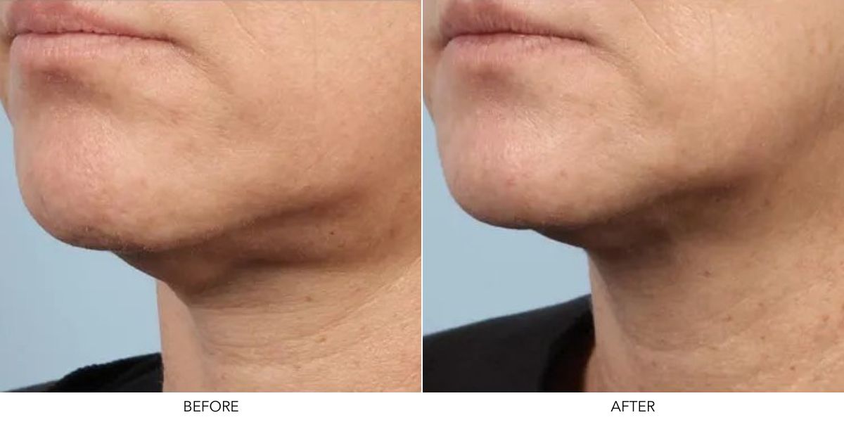 Matrix™ RF Microneedling - Chic Med Laser & Esthetic Center