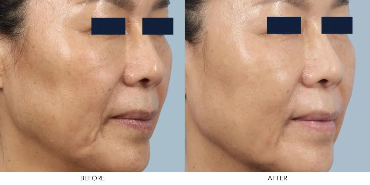 Matrix™ RF Microneedling - Chic Med Laser & Esthetic Center
